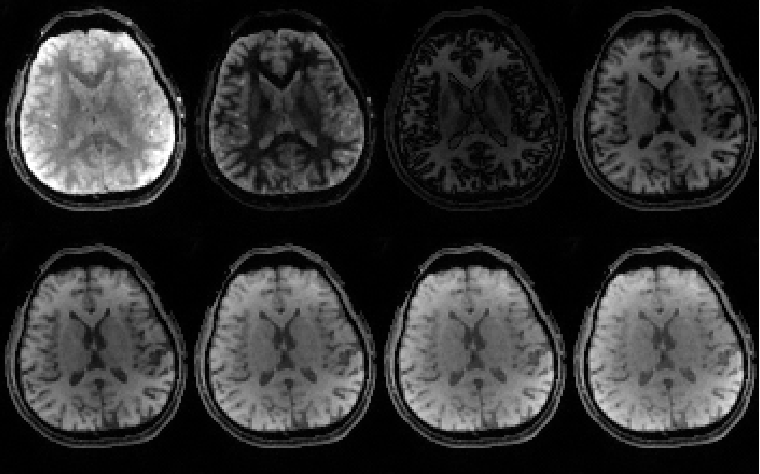 基于EPTI的运动伪影矫正
